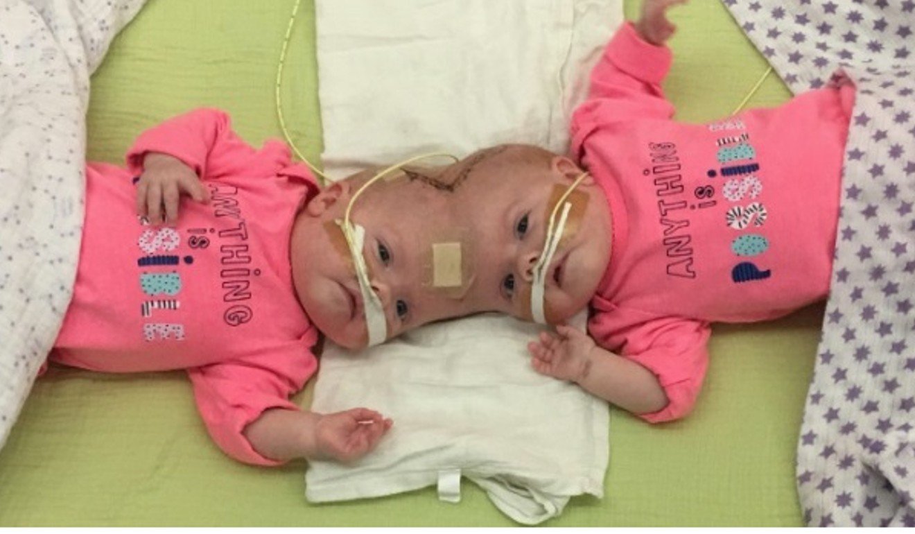 Abby and Erin, once joined at the head, survived one of the world’s ...