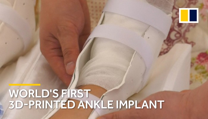 World's first 3D-printed ankle implant helps Chinese woman walk again ...