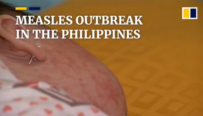 Philippine health officials declare Measles outbreak in Metro Manila ...